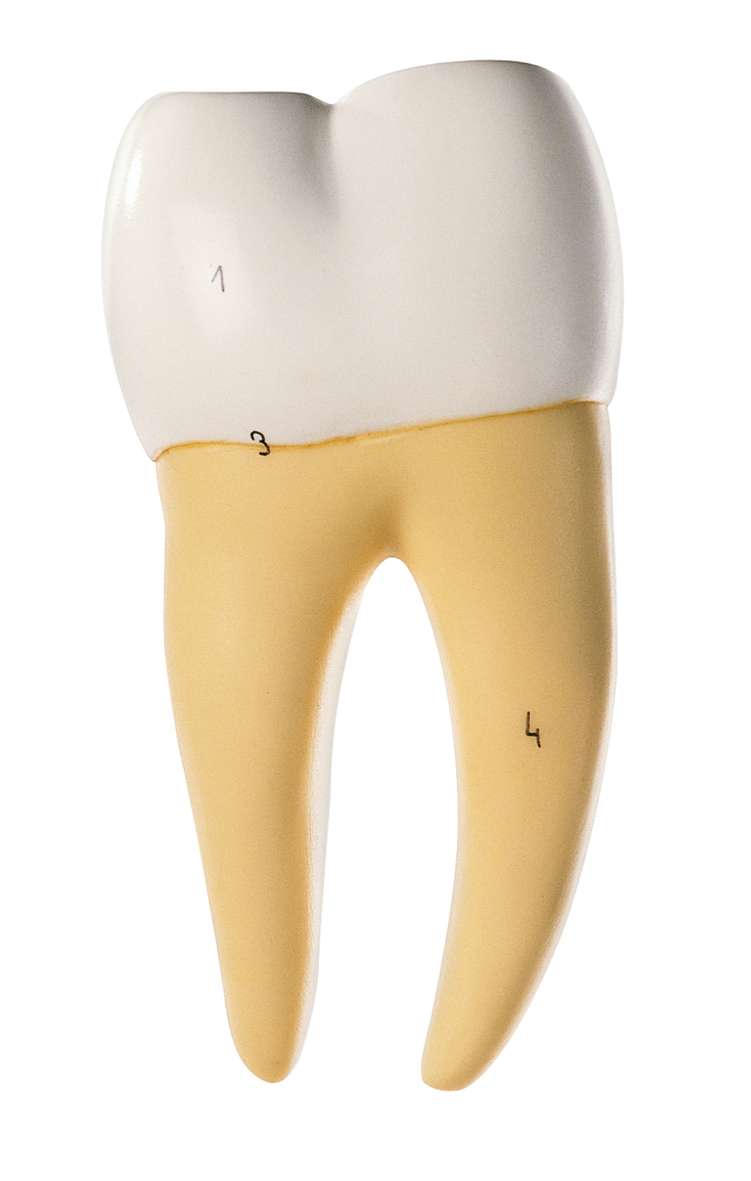 Backenzahn mit Karies | Zahnmodelle vergrößert | Mundhöhle | Kopf ...