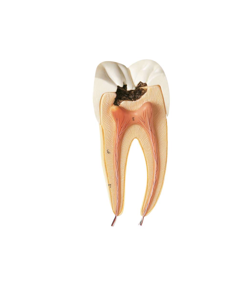 Backenzahn mit Karies | Zahnmodelle vergrößert | Mundhöhle | Kopf ...