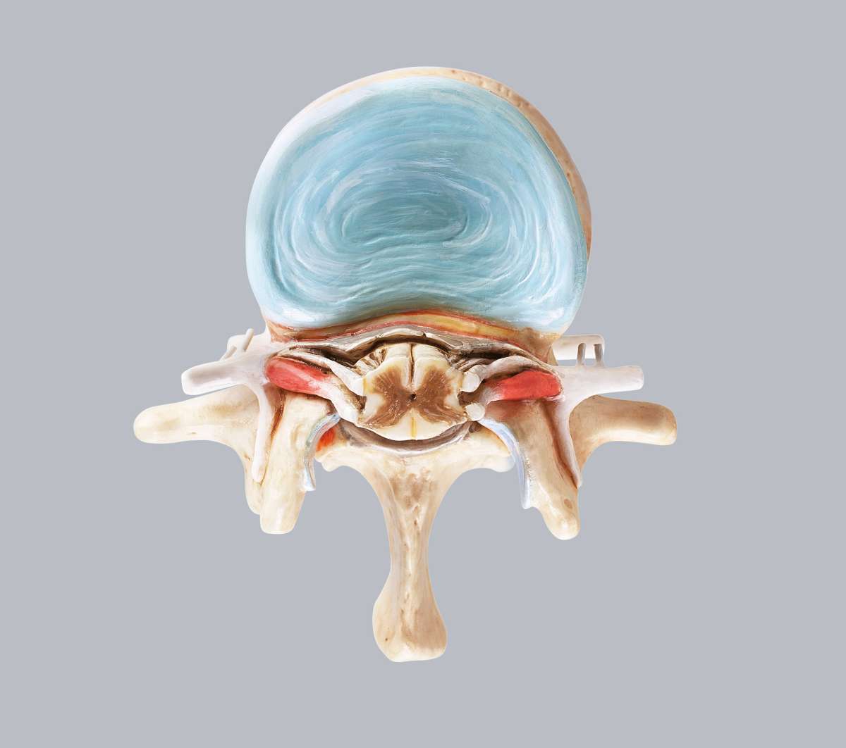 Lendenwirbel (L II) mit Lendenmark | Wirbel mit Rückenmark ...